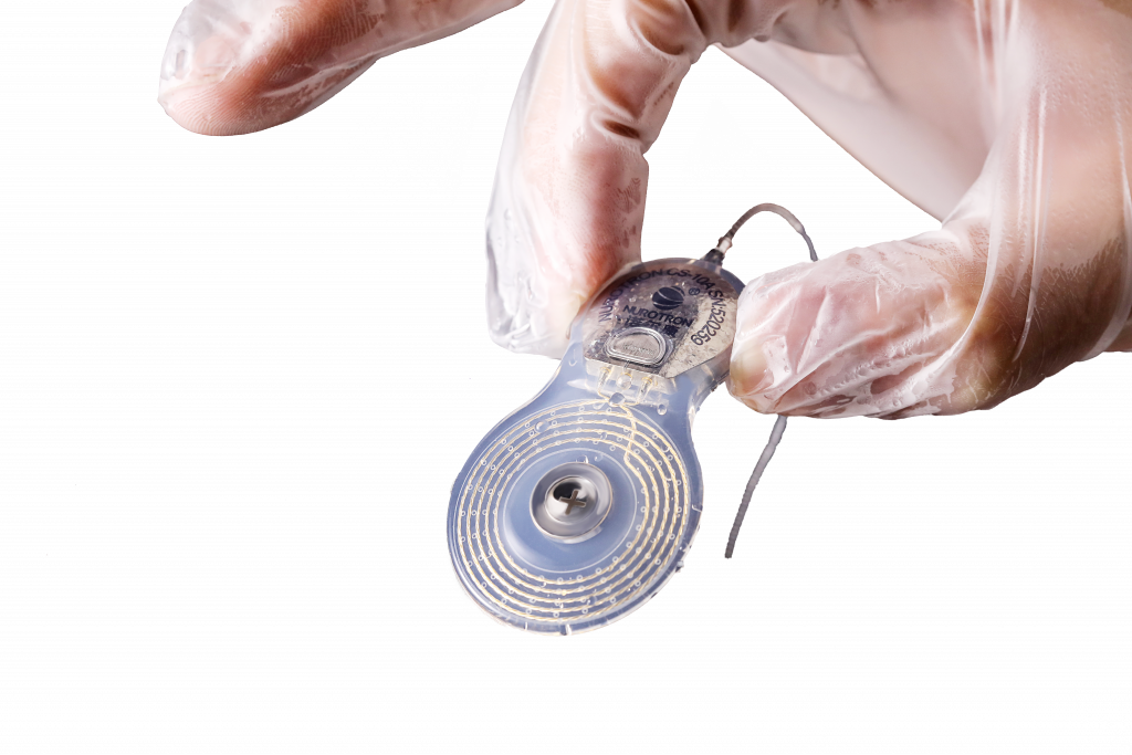 Bilateral Cochlear Implants for Severe Hearing Loss - Nurotron